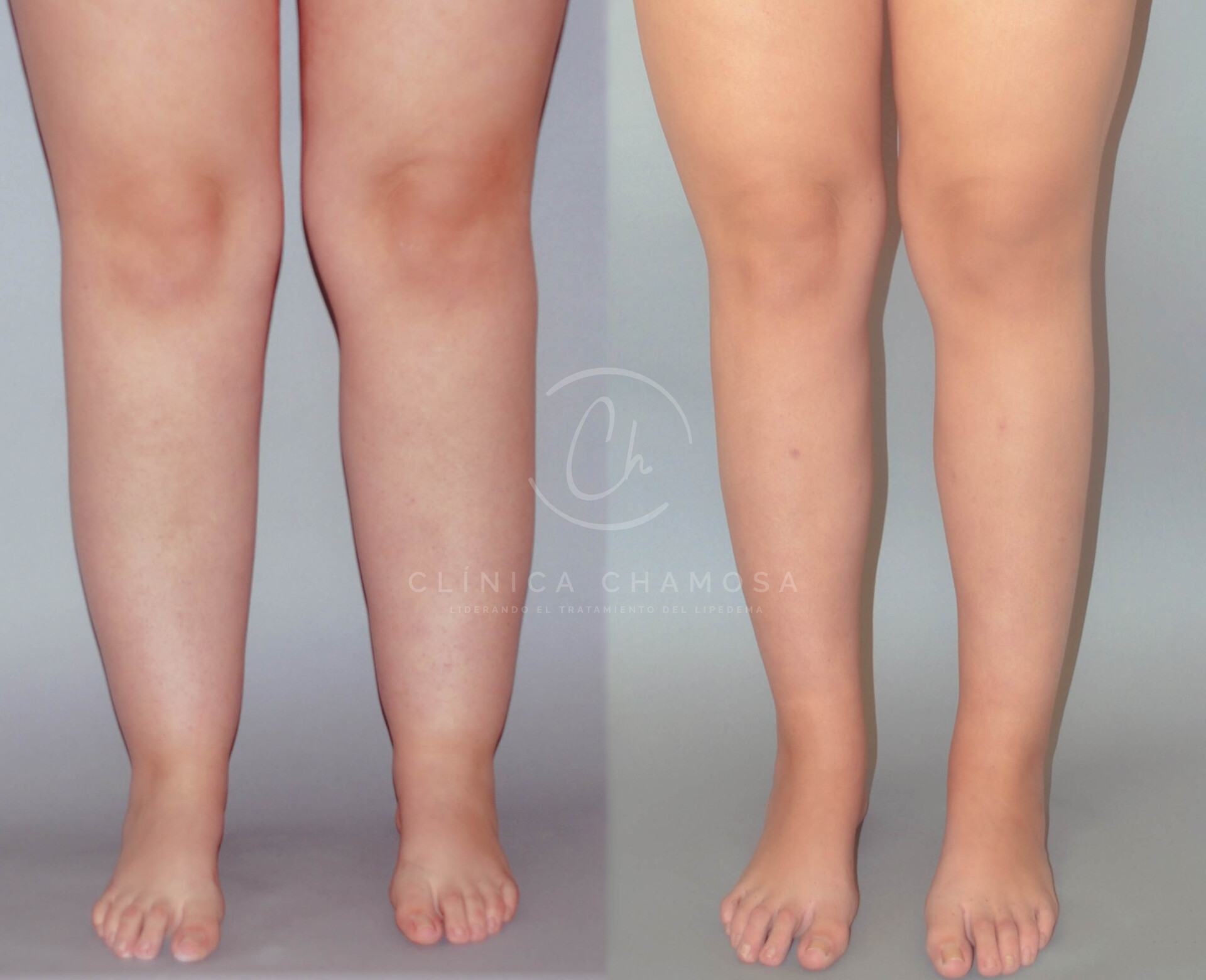 Clínica Chamosa - Líderes en el tratamiento del Lipedema